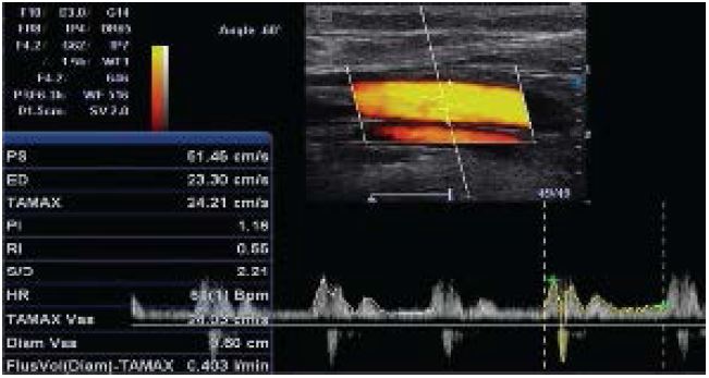 Percutaneous Endovascular Treatment of one Pseudoaneurysm of an AVF ...