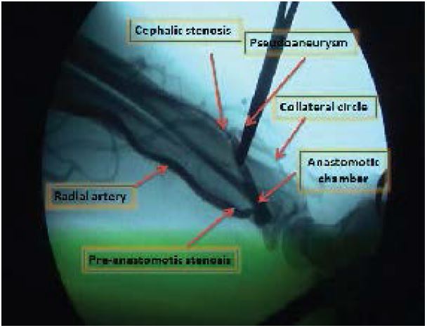 Percutaneous Endovascular Treatment of one Pseudoaneurysm of an AVF ...
