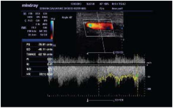 Percutaneous Endovascular Treatment of one Pseudoaneurysm of an AVF ...