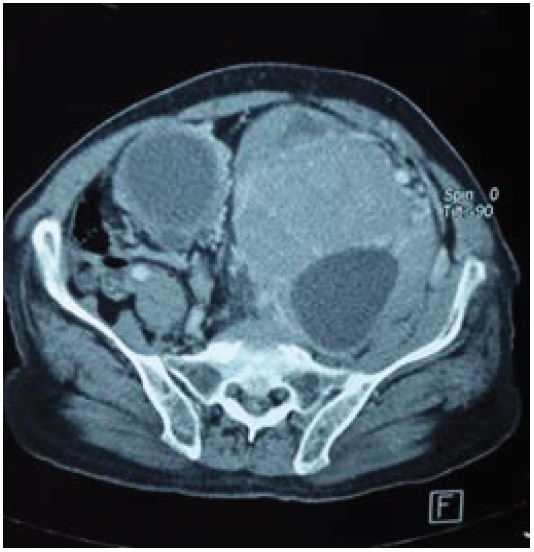 Abdominal Pelvic Mass Revealing a Giant Prostatic Adenocarcinoma