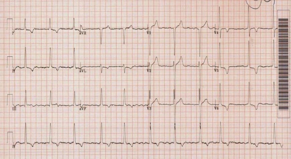 A Clinically and Echocardiographically Demonstrable Dynamic Left ...