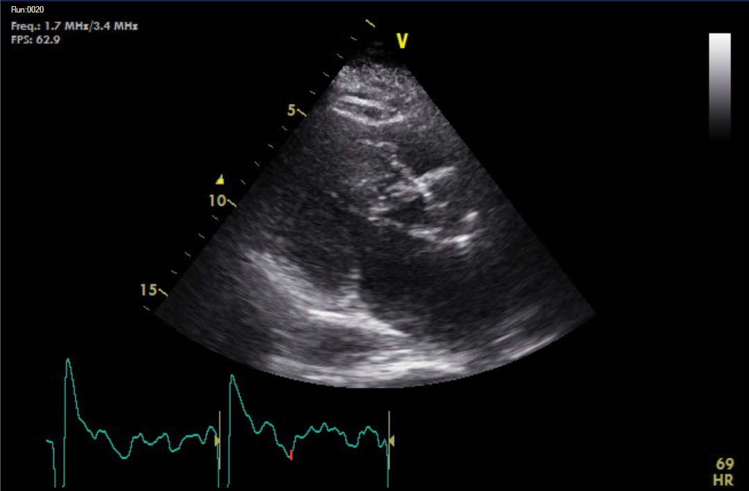 A Clinically and Echocardiographically Demonstrable Dynamic Left ...