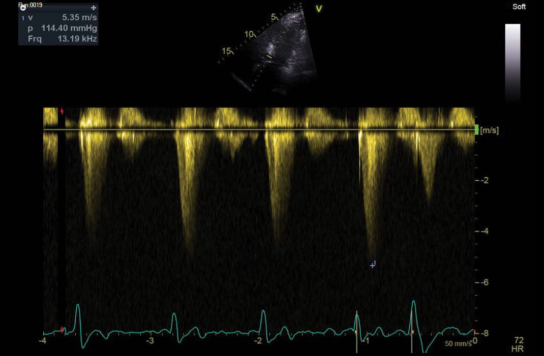 A Clinically and Echocardiographically Demonstrable Dynamic Left ...