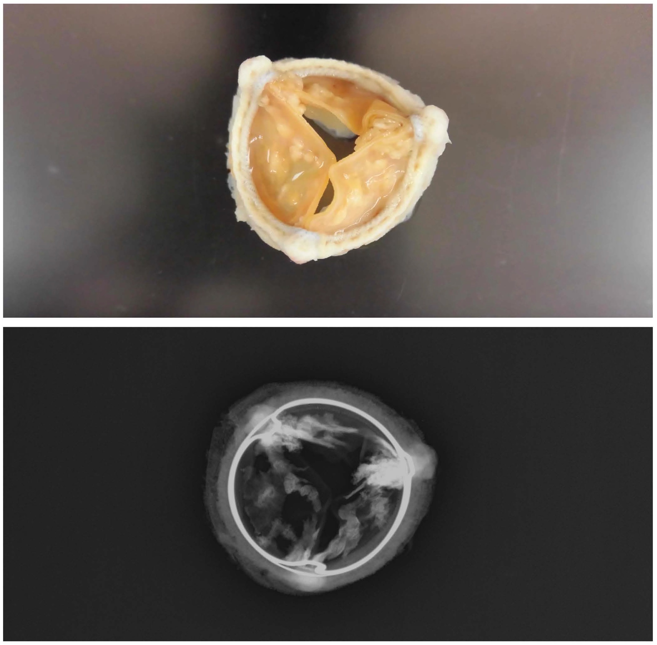 Rapid Progression of Bioprosthetic Aortic Valve Calcification in a ...