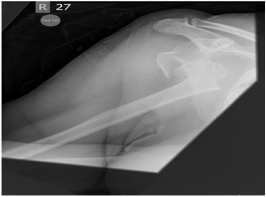 Reverse Total Shoulder Arthroplasty for the Acute Management of ...