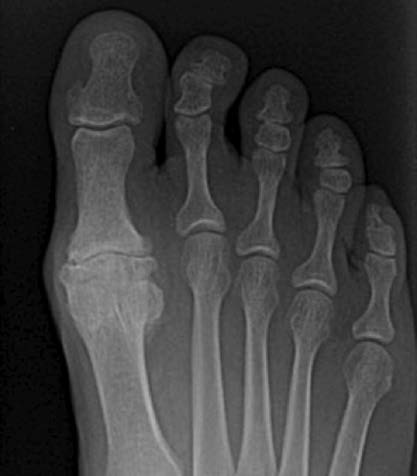 Non-Union Rates Following Crossed Compression Screw Fixation for First ...